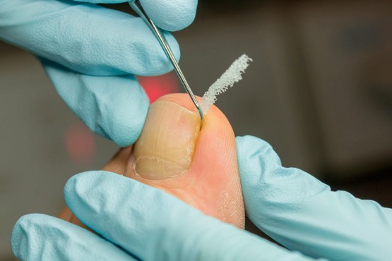 Ingrown tånegl behandling: Farvel til smerte og betennelse | Krediblog