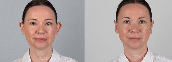 La solución más sencilla y eficaz para las orejas de soplillo - D+