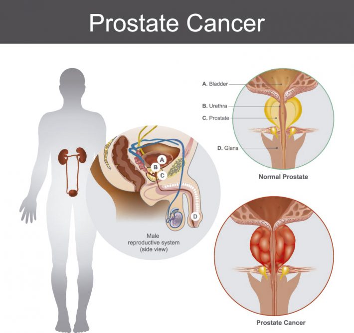 Cáncer De Próstata Síntomas Factores De Riesgo Y Tratamiento