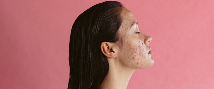 Los tipos de acné: ¿Cuáles hay y cómo se tratan? | Doctología