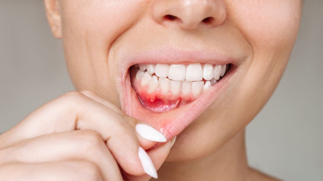 ¿Cómo curar una úlcera bucal? | Doctología